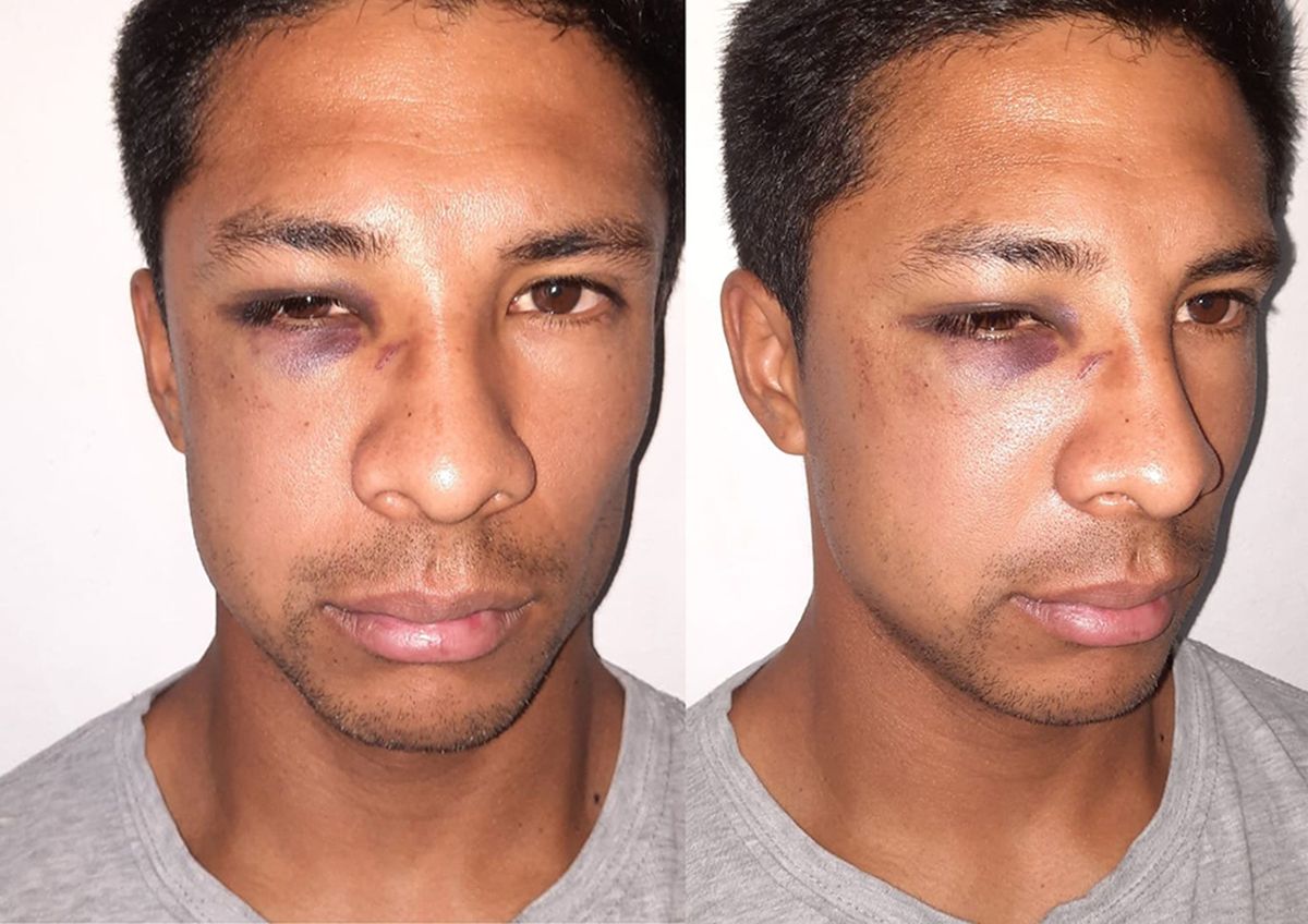 Agustín Muñoz deberá ser intervenido cuanto antes con una prótesis en ...