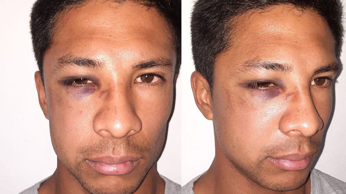 Agustín Muñoz deberá ser intervenido cuanto antes con una prótesis en ...