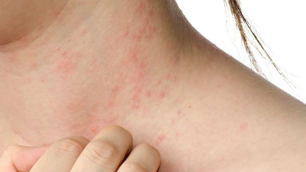 Dermatitis atópica, una patología que atraviesa la vida del paciente